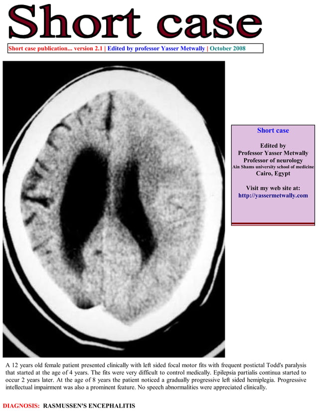 Short case...Rasmussen's encephalitis | PDF
