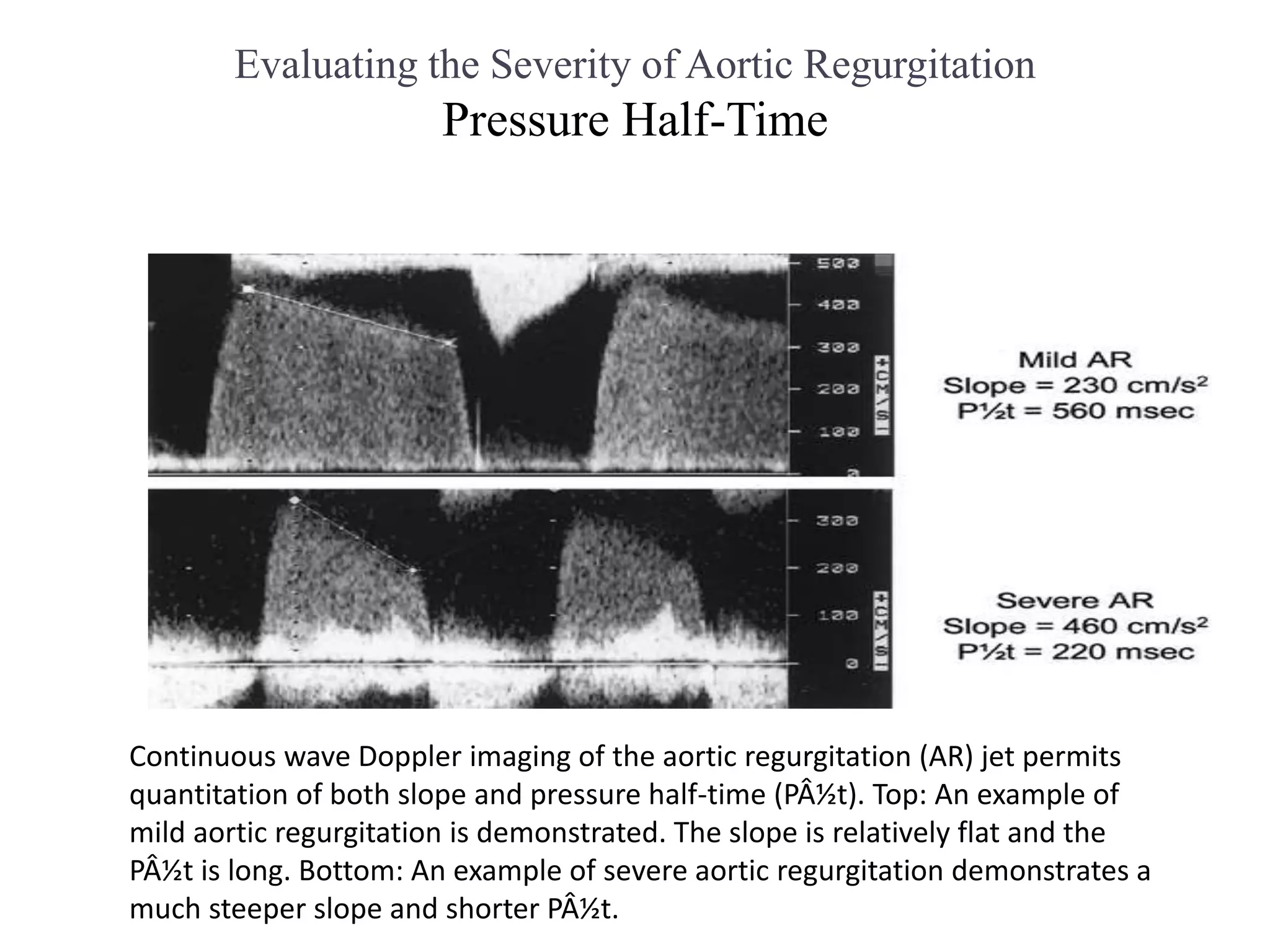 Echocardiography assessment of Aortic Regurgitation severity | PPTX