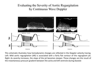 Echocardiography assessment of Aortic Regurgitation severity | PPTX