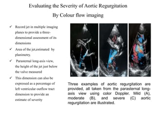 Echocardiography assessment of Aortic Regurgitation severity | PPTX