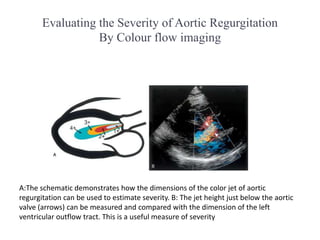 Echocardiography assessment of Aortic Regurgitation severity | PPTX