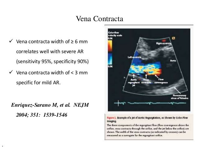 Echocardiography assessment of Aortic Regurgitation severity