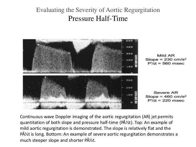 Echocardiography assessment of Aortic Regurgitation severity