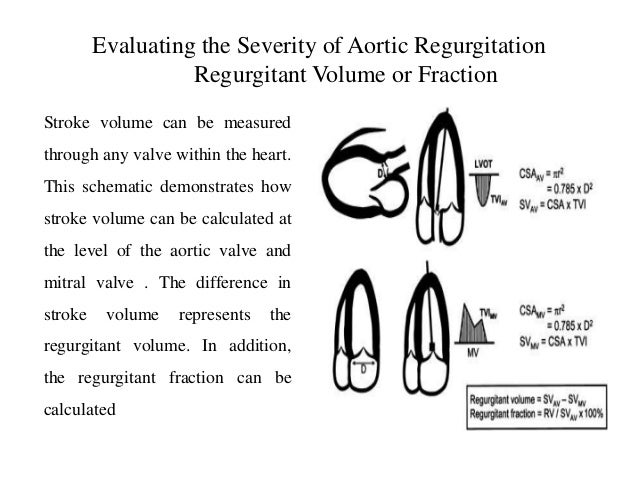 Echocardiography assessment of Aortic Regurgitation severity