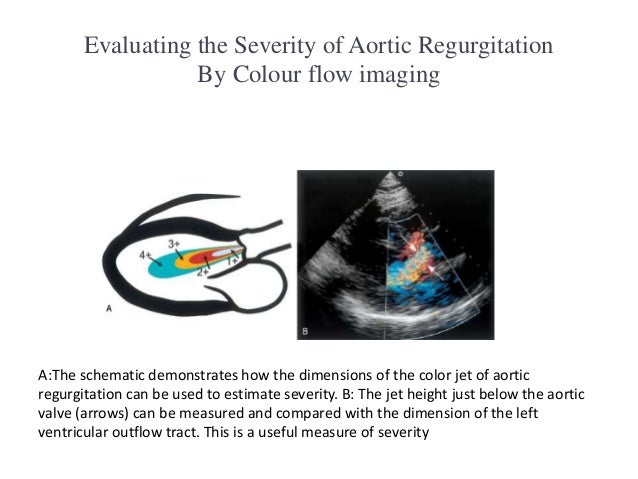 Echocardiography assessment of Aortic Regurgitation severity