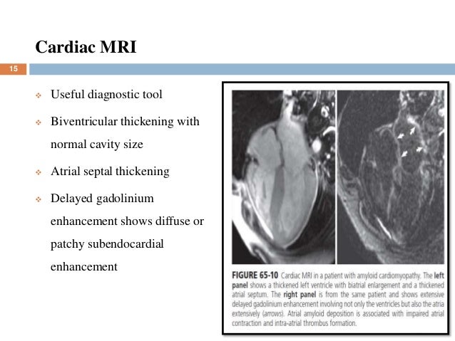 Normal Lv Size Cardiac Mri | Paul Smith