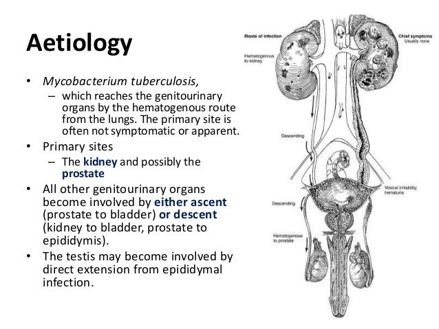 Short review of genitourinary tuberculosis