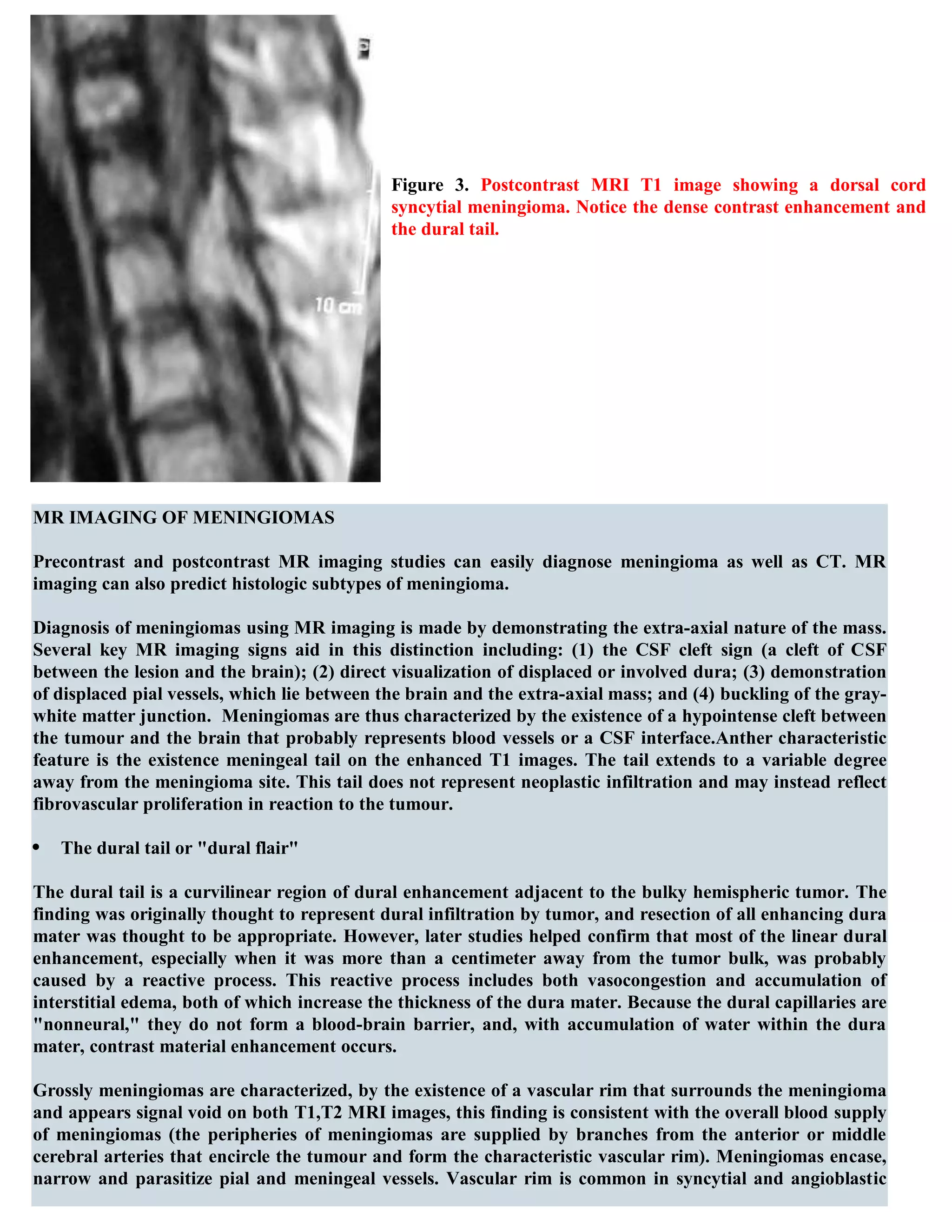 Short case...Spinal meningioma | PDF