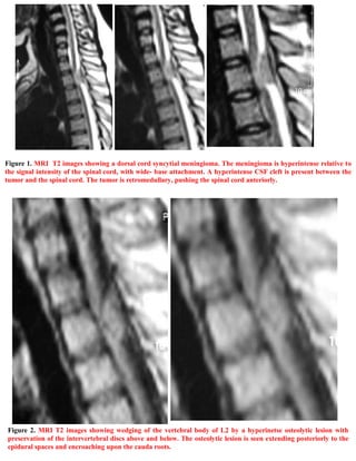 Short case...Spinal meningioma | PDF