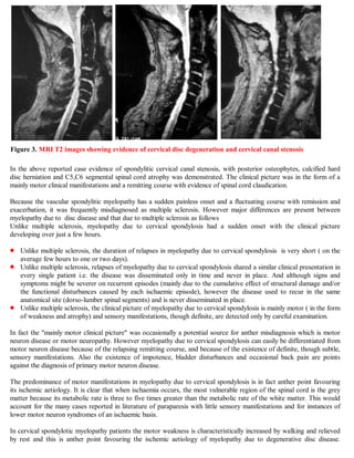 Short case...Cervical vascular spondylotic myelopathy | PDF