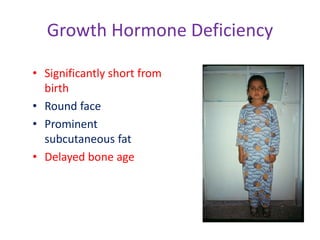 Growth Hormone Deficiency Facial Features