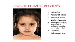 Growth Hormone Deficiency Facial Features