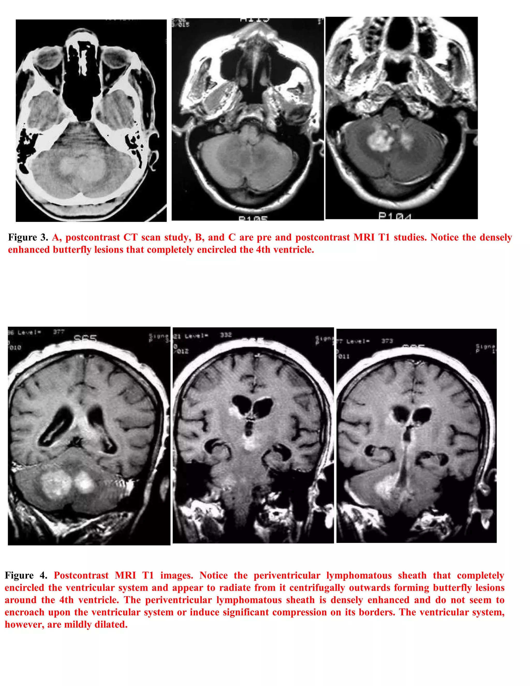 Short case......Primary subependymal CNS lymphoma (MRI approach) | PDF