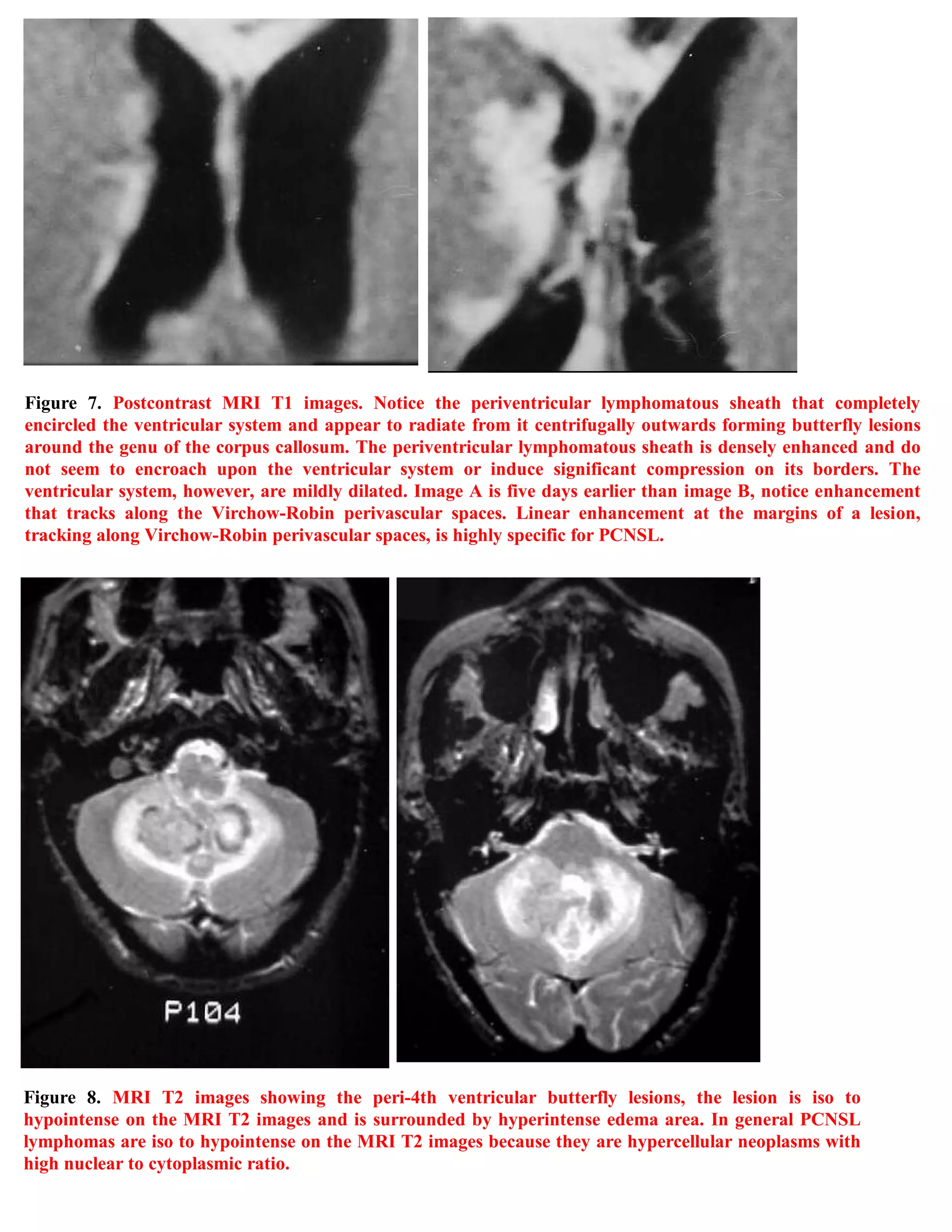 Short case......Primary subependymal CNS lymphoma (MRI approach) | PDF