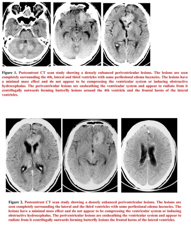 Short case......Primary subependymal CNS lymphoma (MRI approach) | PDF