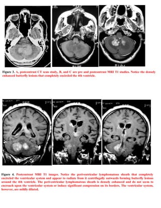 Short case......Primary subependymal CNS lymphoma (MRI approach) | PDF