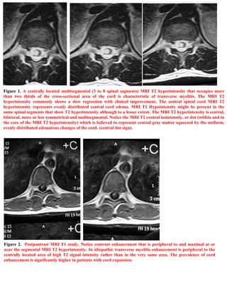 Short case...Acute postinfectious transverse myelitis | PDF