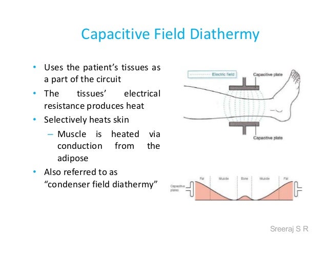 Short wave diathermy srs