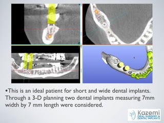 Dr. Hamid Ryan Kazemi discusses short & wide dental implants | PPT