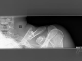 Shoulder Dislocation | PPT