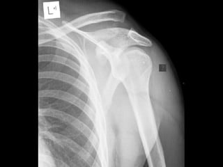 Shoulder Dislocation | PPT