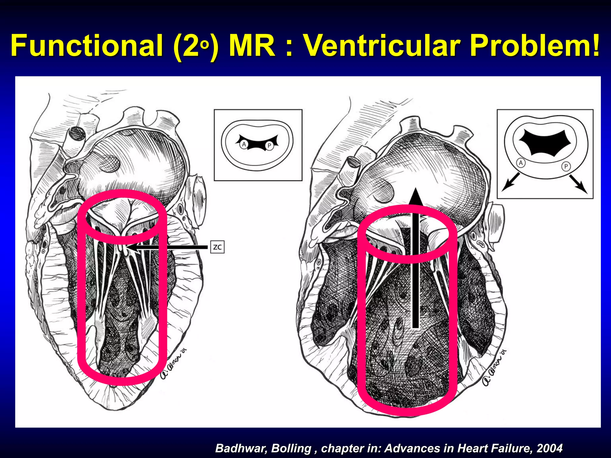 Should functional mr be fixed in heart failure | PDF