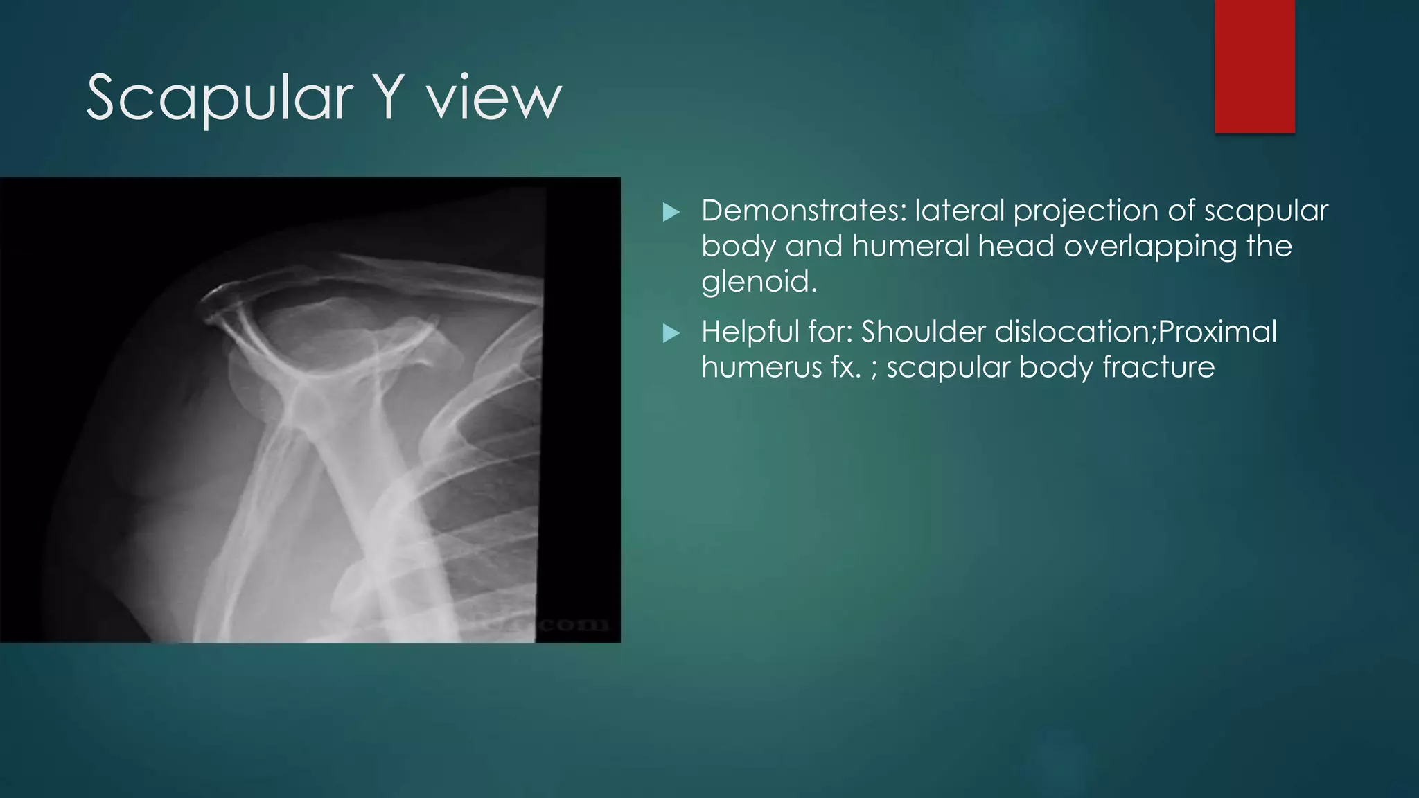 RADIOLOGICAL ANATOMY OF UPPER LIMB(SHOULDER@ELBOW) | PPTX