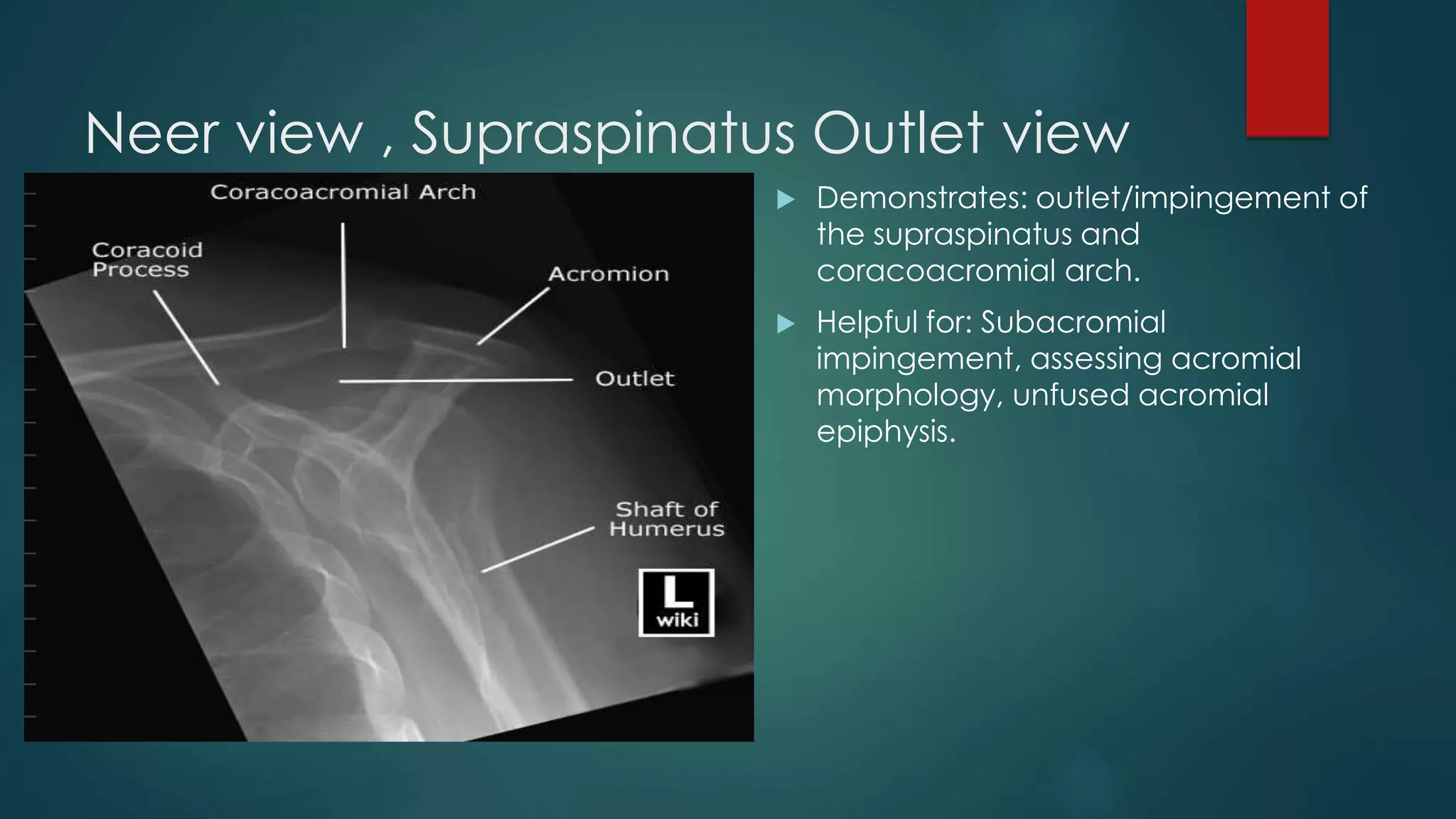 RADIOLOGICAL ANATOMY OF UPPER LIMB(SHOULDER@ELBOW) | PPTX
