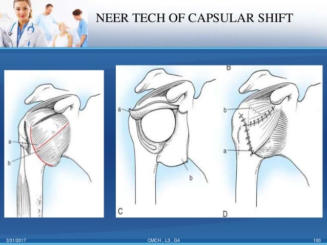 Shoulder dislocation Co Norbert