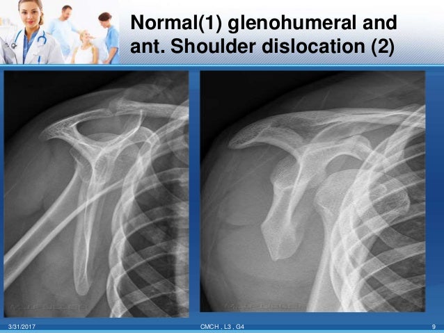 Shoulder dislocation Co Norbert