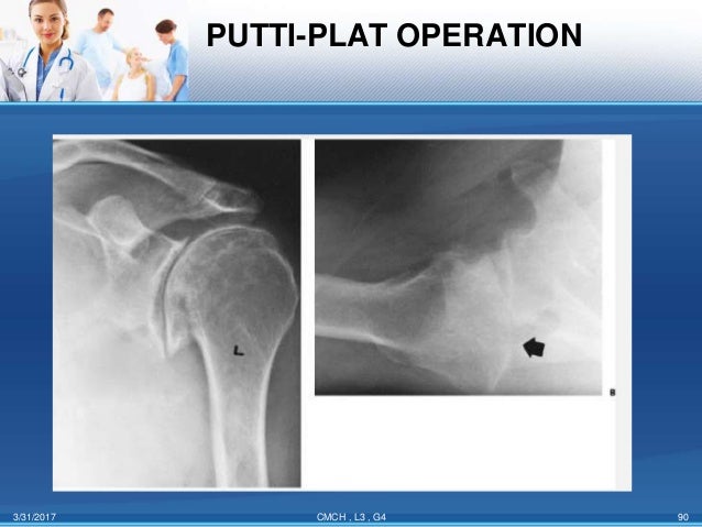 Shoulder dislocation Co Norbert