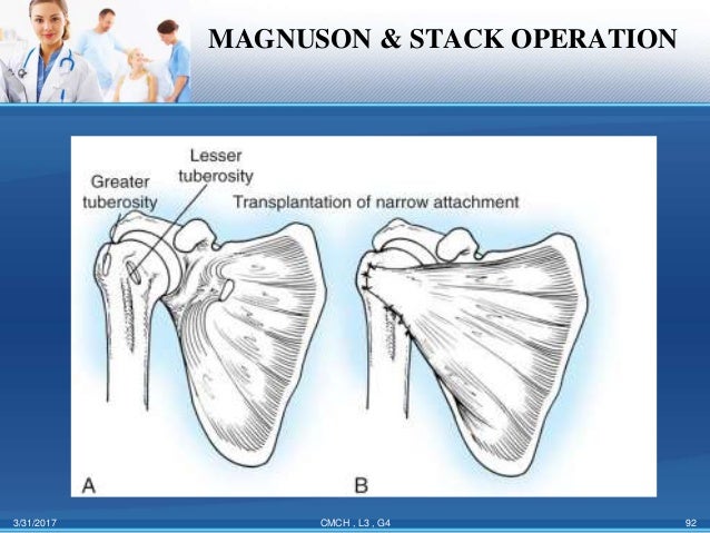 Shoulder dislocation Co Norbert