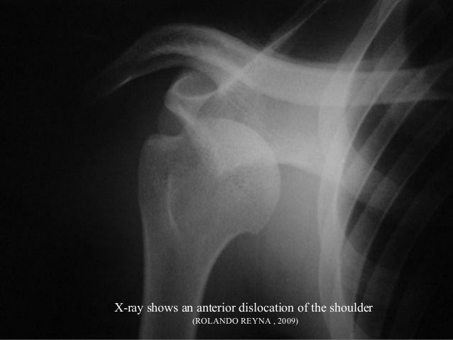 Shoulder Dislocations
