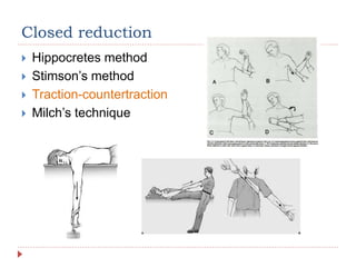 Case conference shoulder dislocation | PPT
