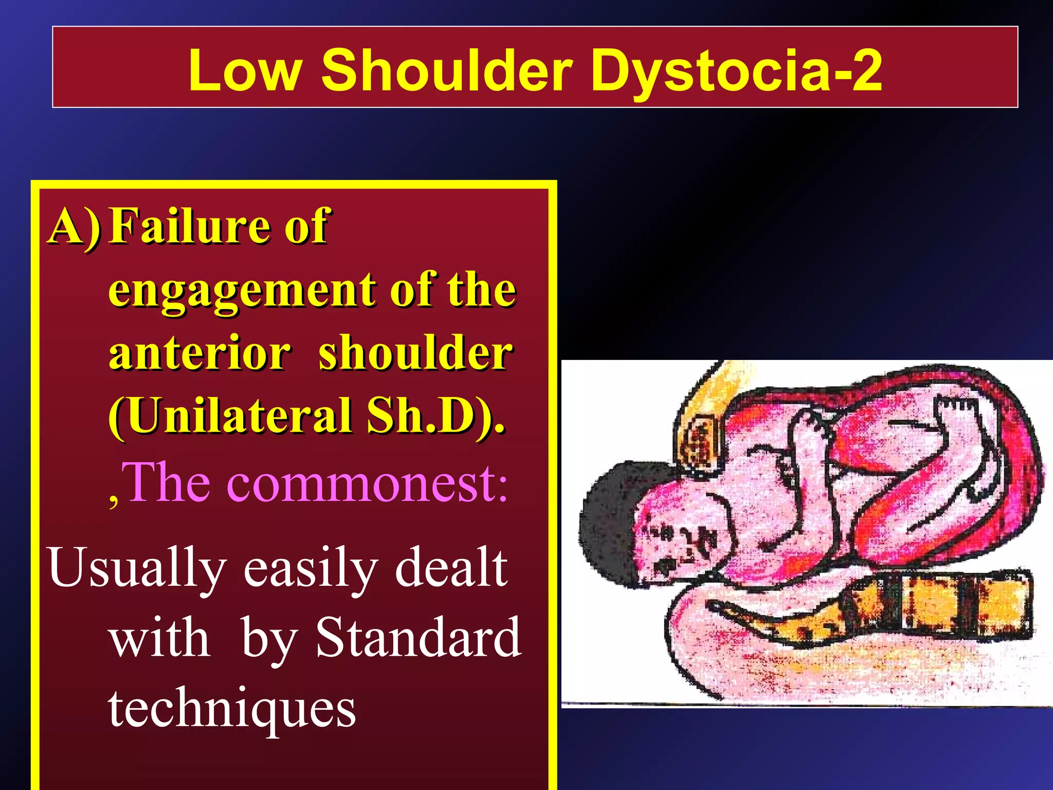 Shoulder dystocia | PPT