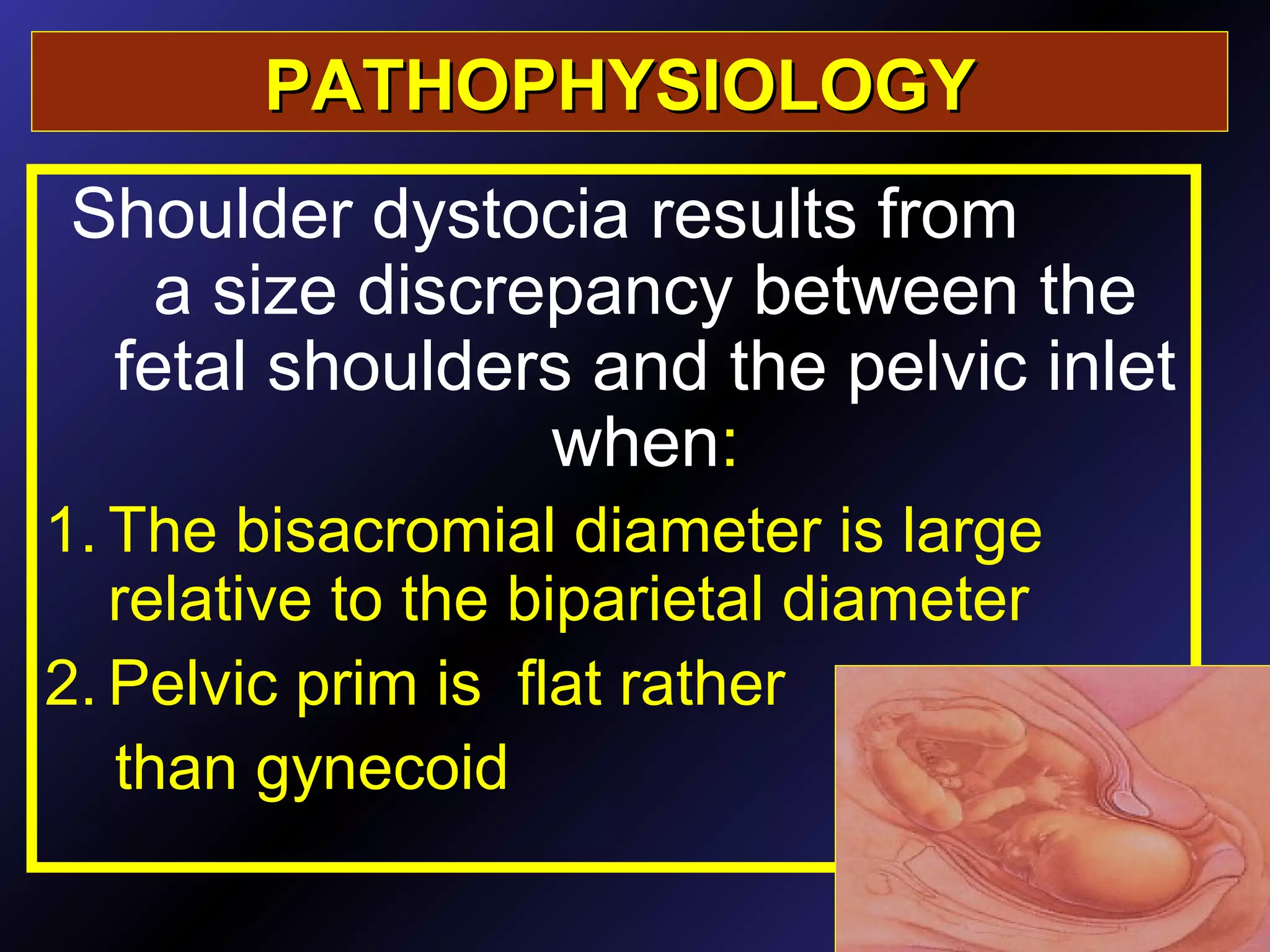 Shoulder dystocia | PPT