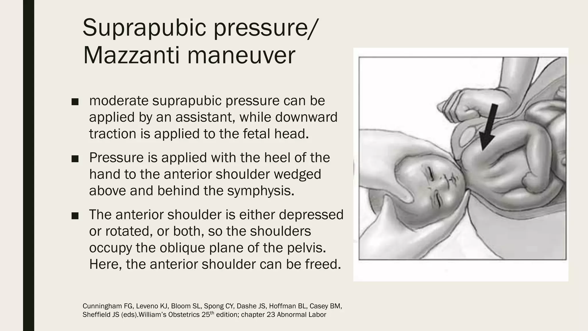 shoulder-dystocia.pdf