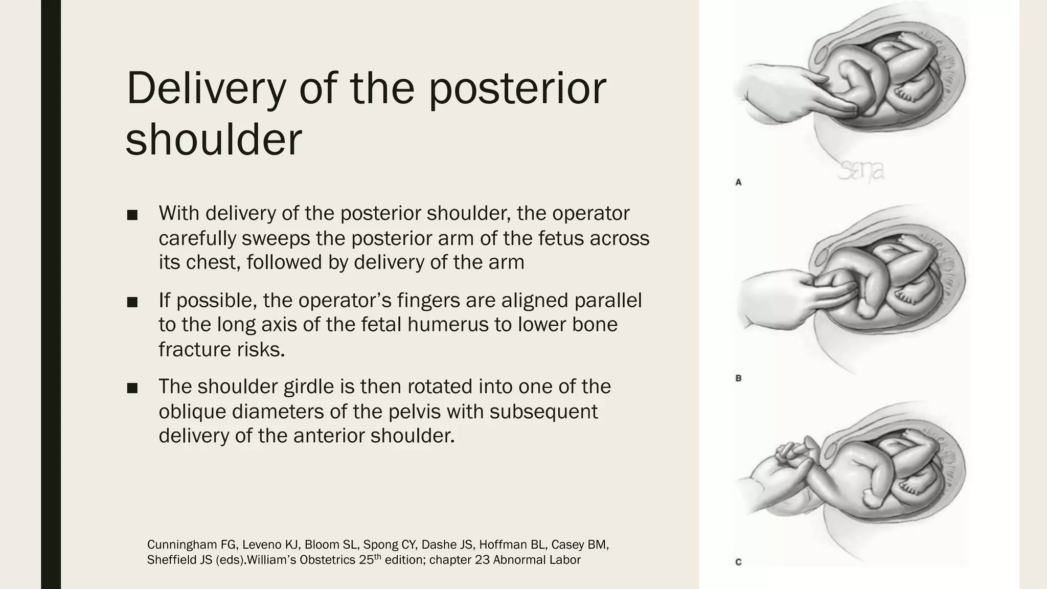 shoulder-dystocia.pdf