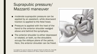 shoulder-dystocia.pdf