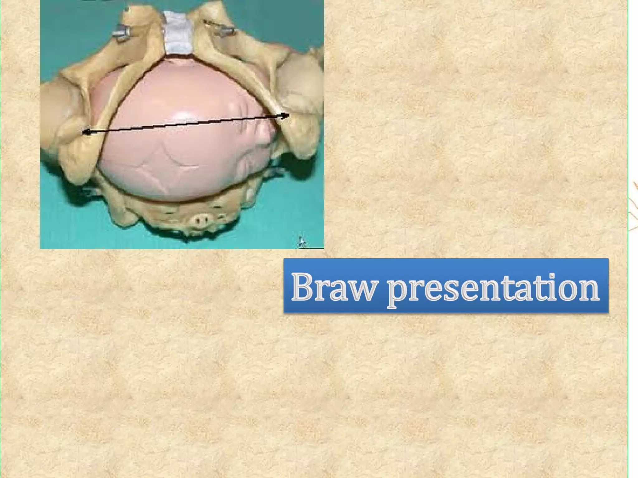 Shoulder presentation | PPT