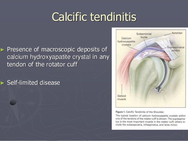 Shoulder supraspinatus calcific tendinitis dr.sandeep agrawal agras…
