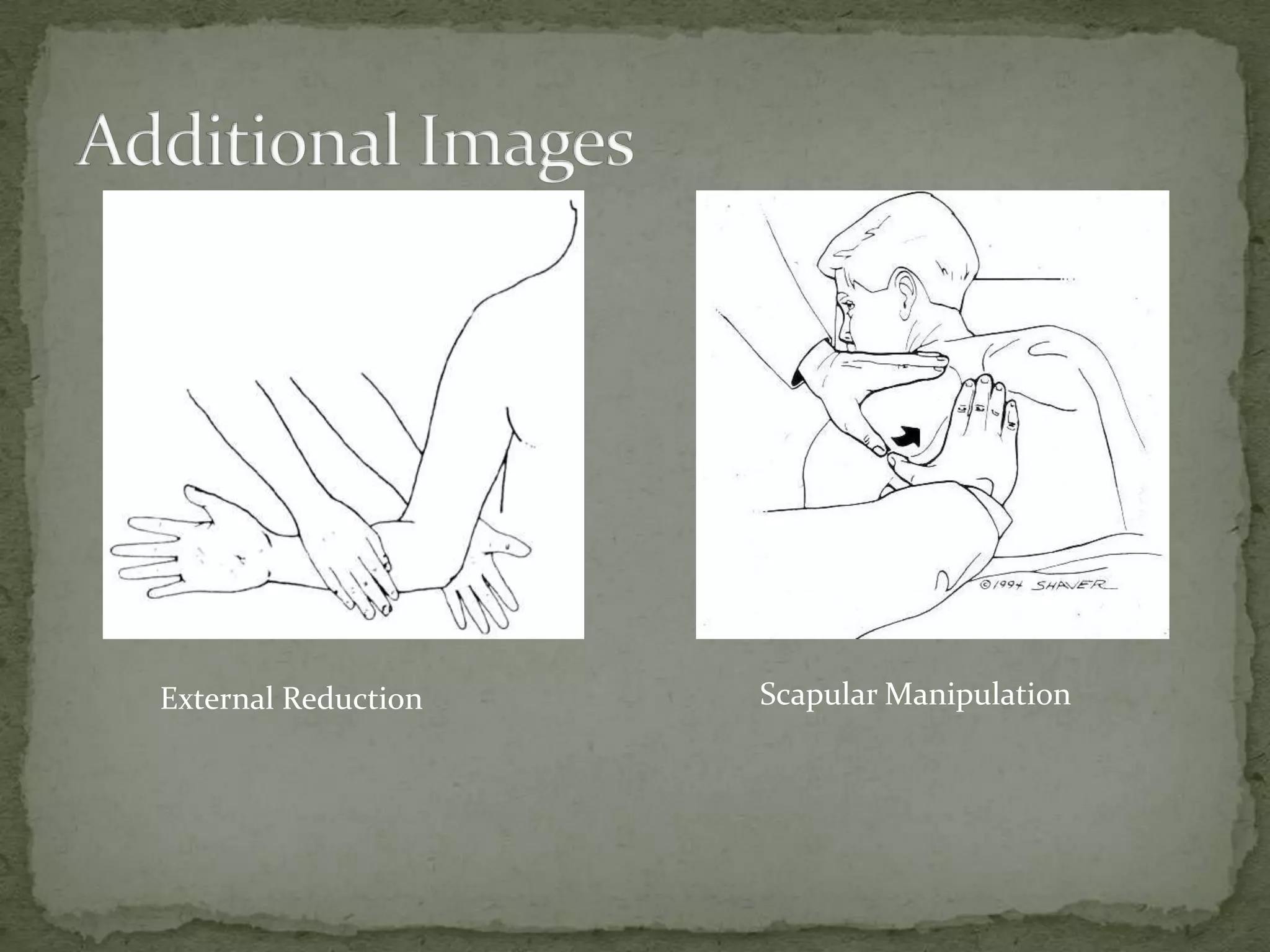 Anterior Shoulder Dislocation | PPTX