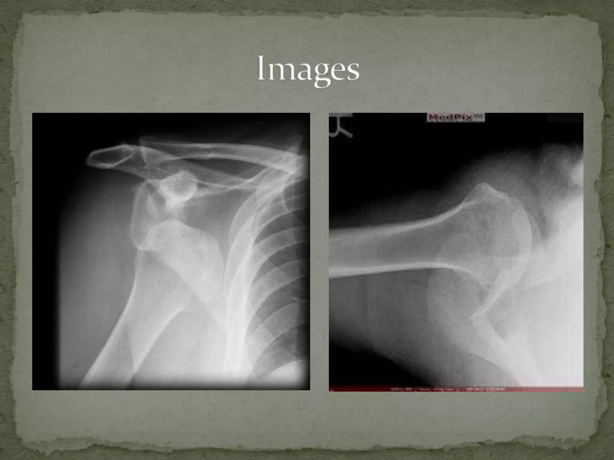 Anterior Shoulder Dislocation | PPTX