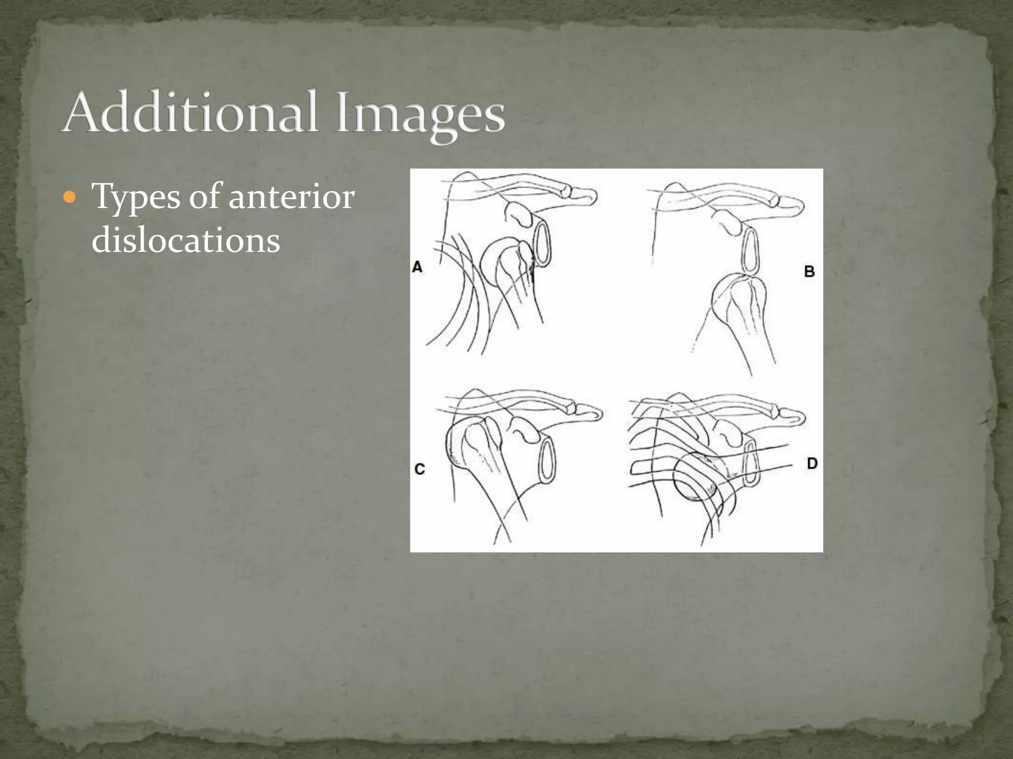 Anterior Shoulder Dislocation | PPTX
