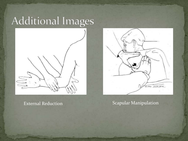 Anterior Shoulder Dislocation | PPTX