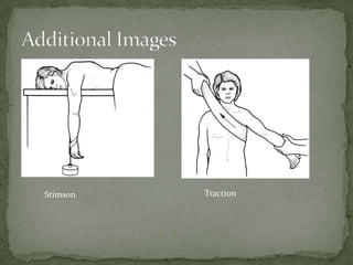 Anterior Shoulder Dislocation | PPTX