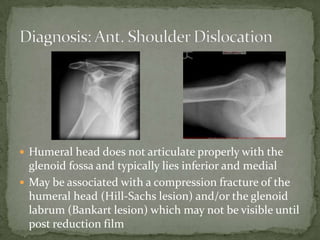 Anterior Shoulder Dislocation | PPTX