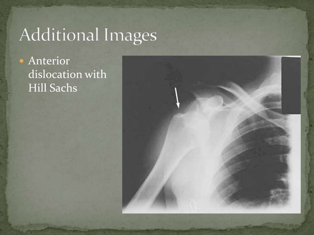 Anterior Shoulder Dislocation | PPTX