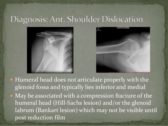 Anterior Shoulder Dislocation