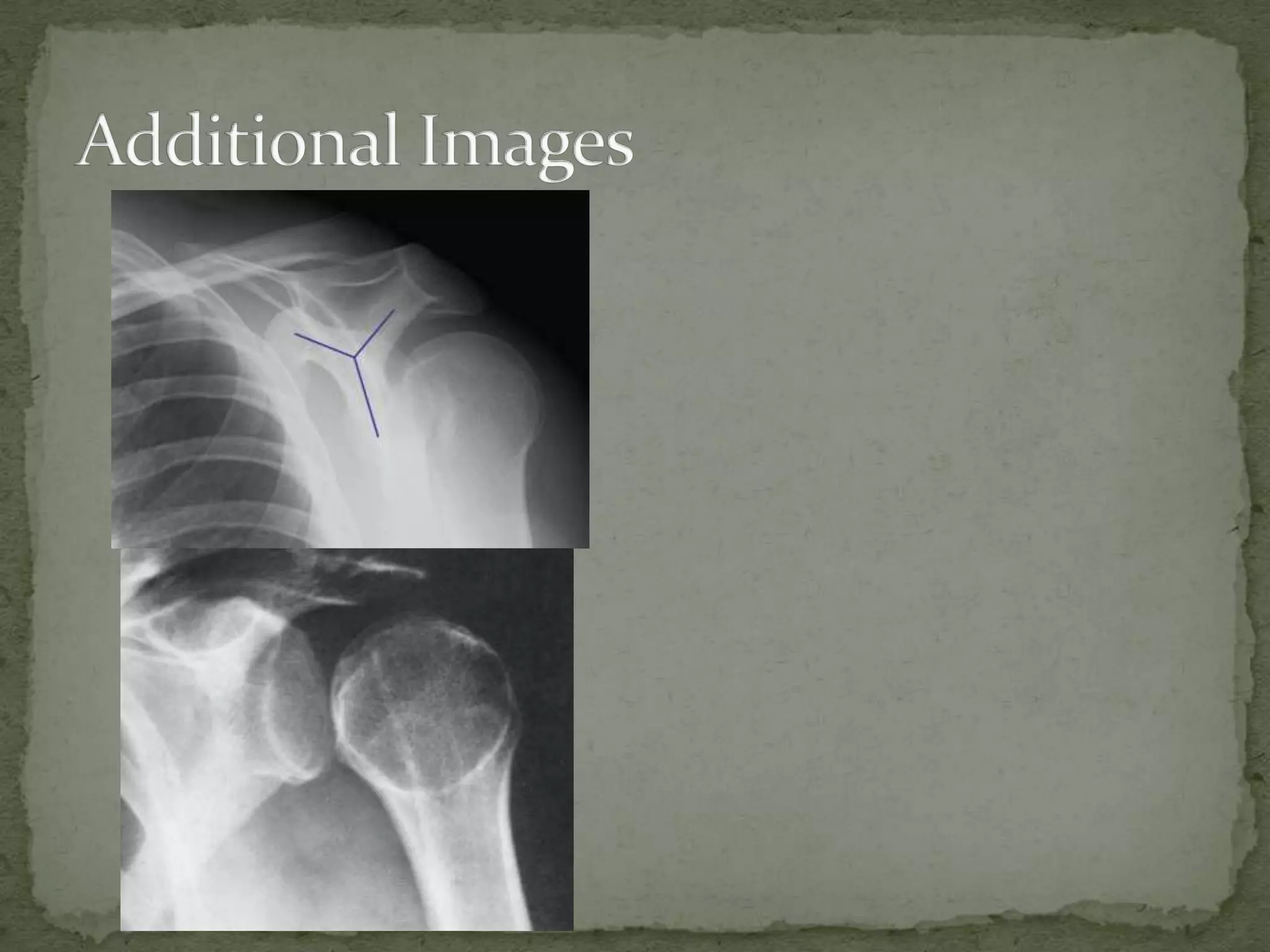 Posterior Shoulder Dislocation | PPTX